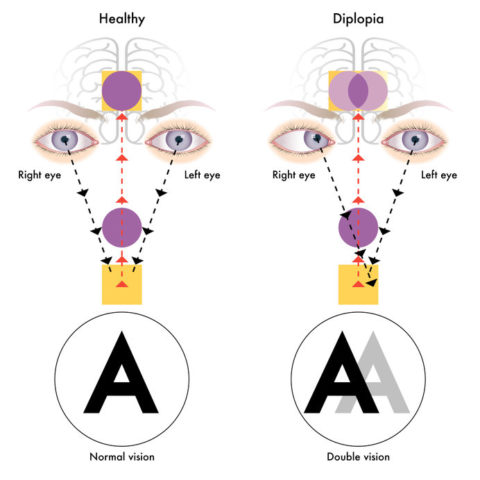 Double Vision - Cause and Treatment | Easy Drug Card